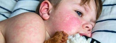 Spálová angína u dětí: Kompletní průvodce příznaky a léčbou ...